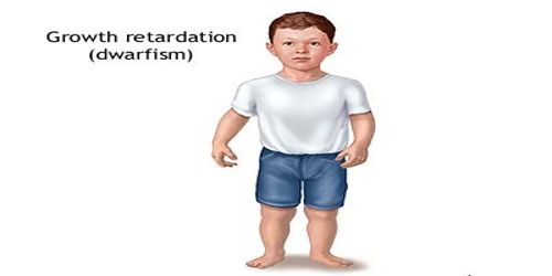 Dwarfism - QS Study